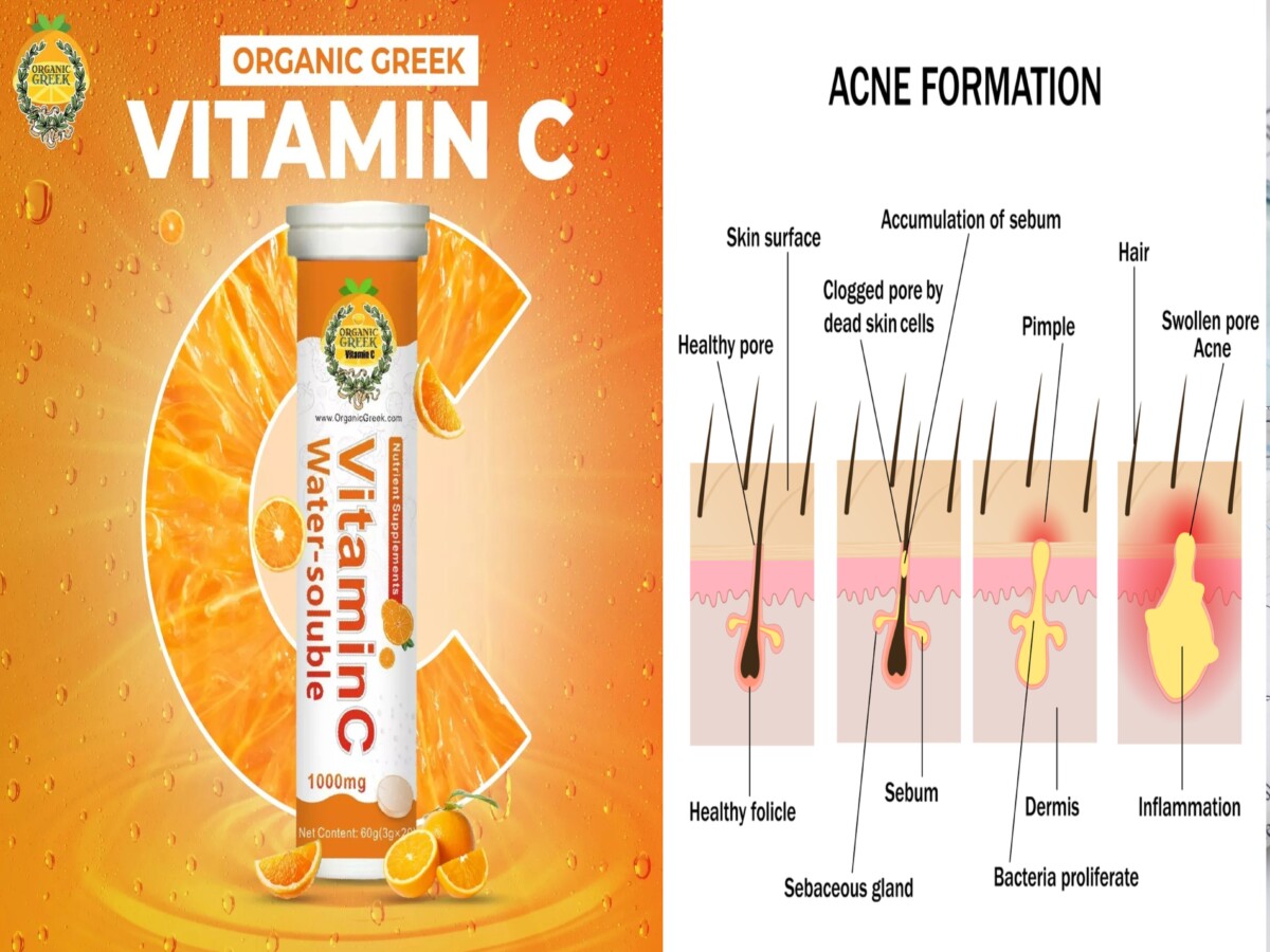 Organic Greek Vitamin C's Breakthrough Role in Giant Pimple Blackhead ...